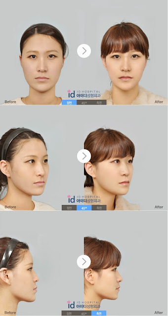 Operasi Plastik di Korea, ID Hospital: Mini V-Line