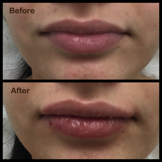 Lip Augmentation Before and After Results