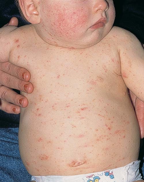 Family Practice Pearls: Treating Scabies
