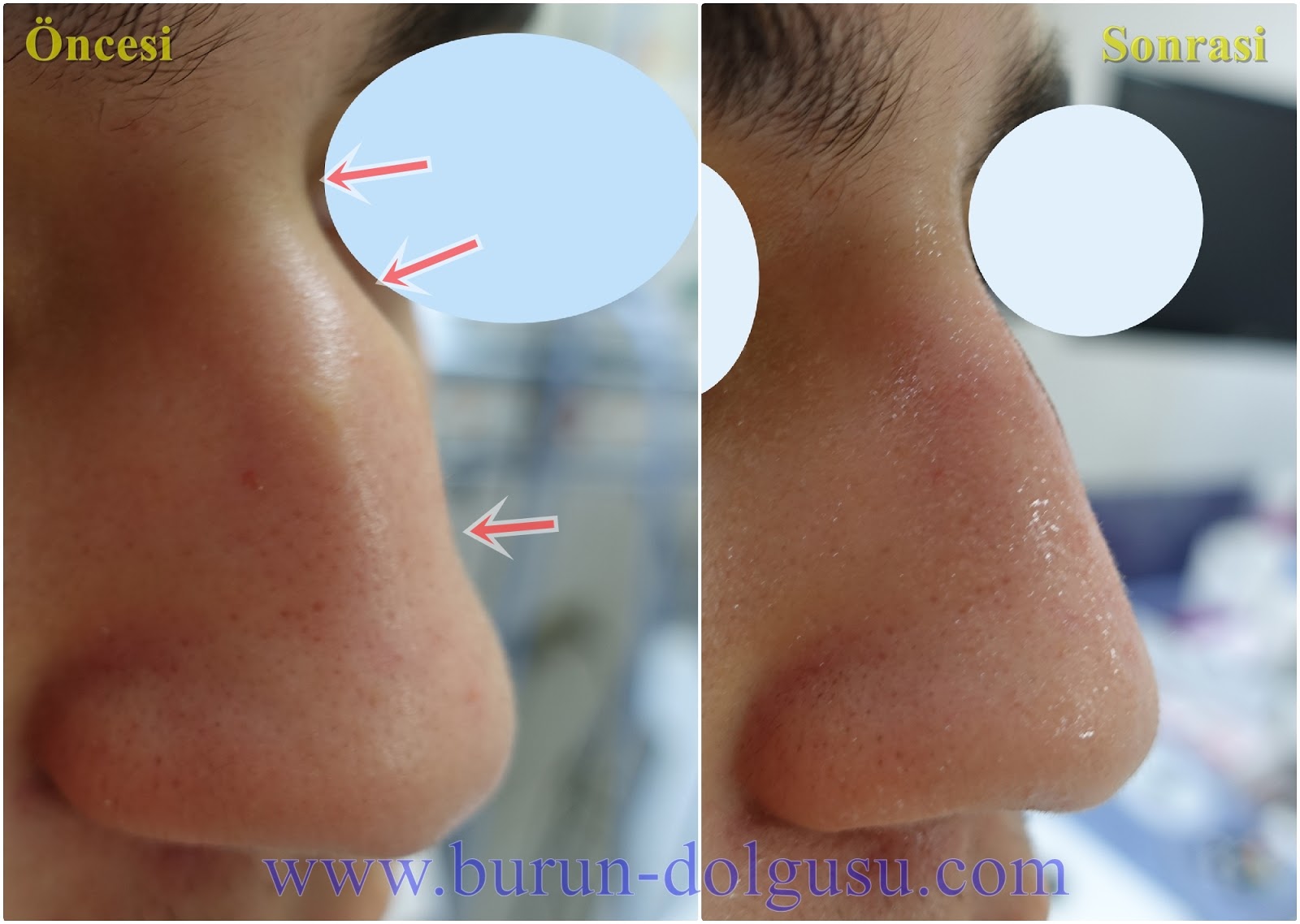 Burun Dolgusu Öncesi ve Sonrası Fotoğrafları