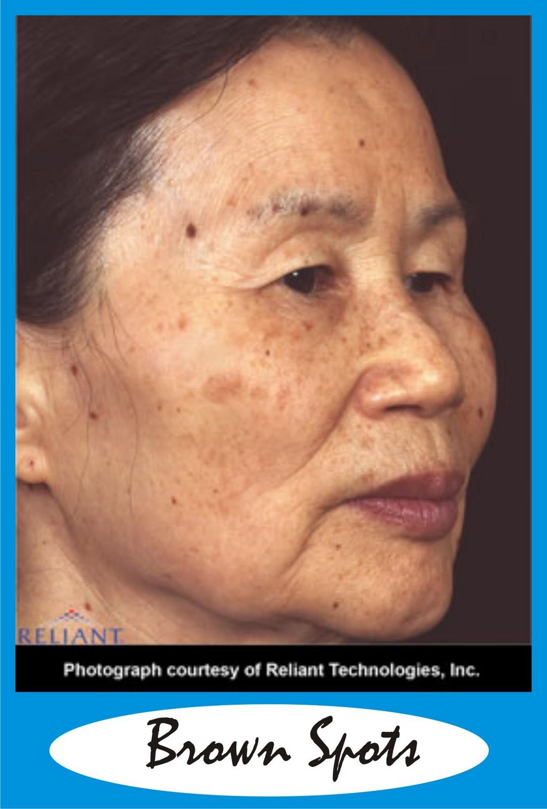 Skin Whitening Forever: Types of Brown Spots – The Skin Problem