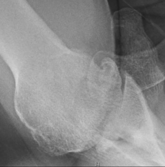 UW Shoulder and Elbow Academy: Ream and run and weight training