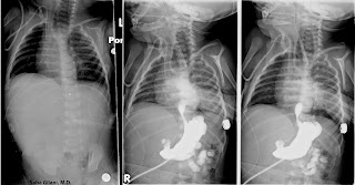 Roentgen Ray Reader: The Spectrum of Esophageal Atresias