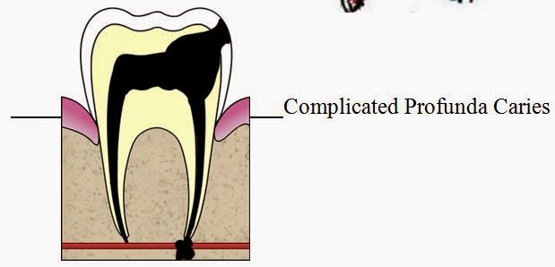 Karies Lubang Gigi, Caries Dentist Medical Articles