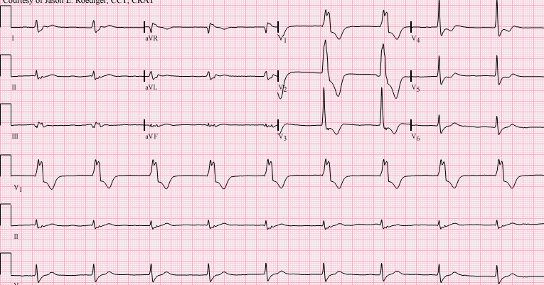 加速性心室自主節律 Accelerated idioventricular rhythm