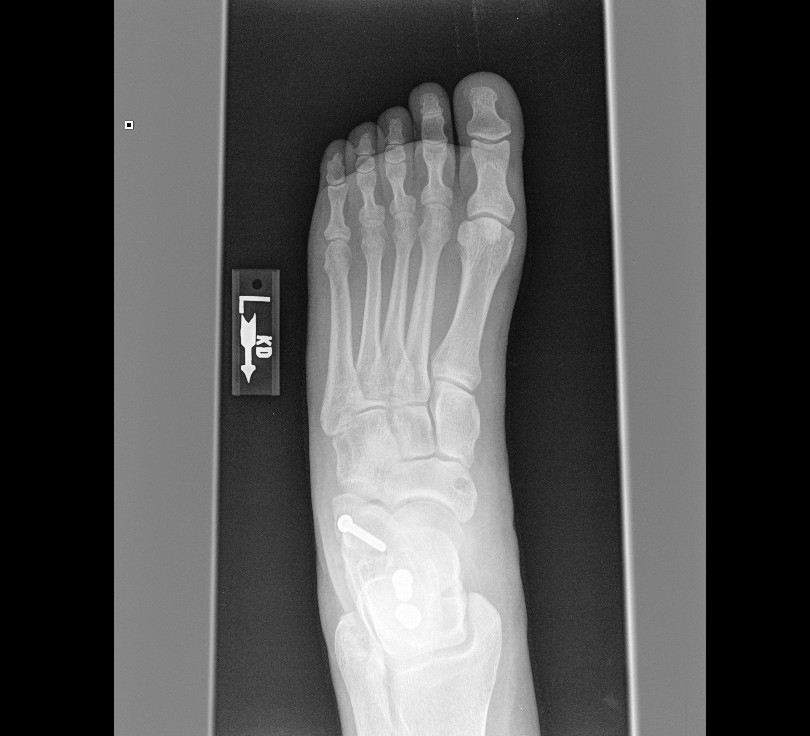 My posterior tibial tendon surgery journey: 2 week check up April 12, 2011