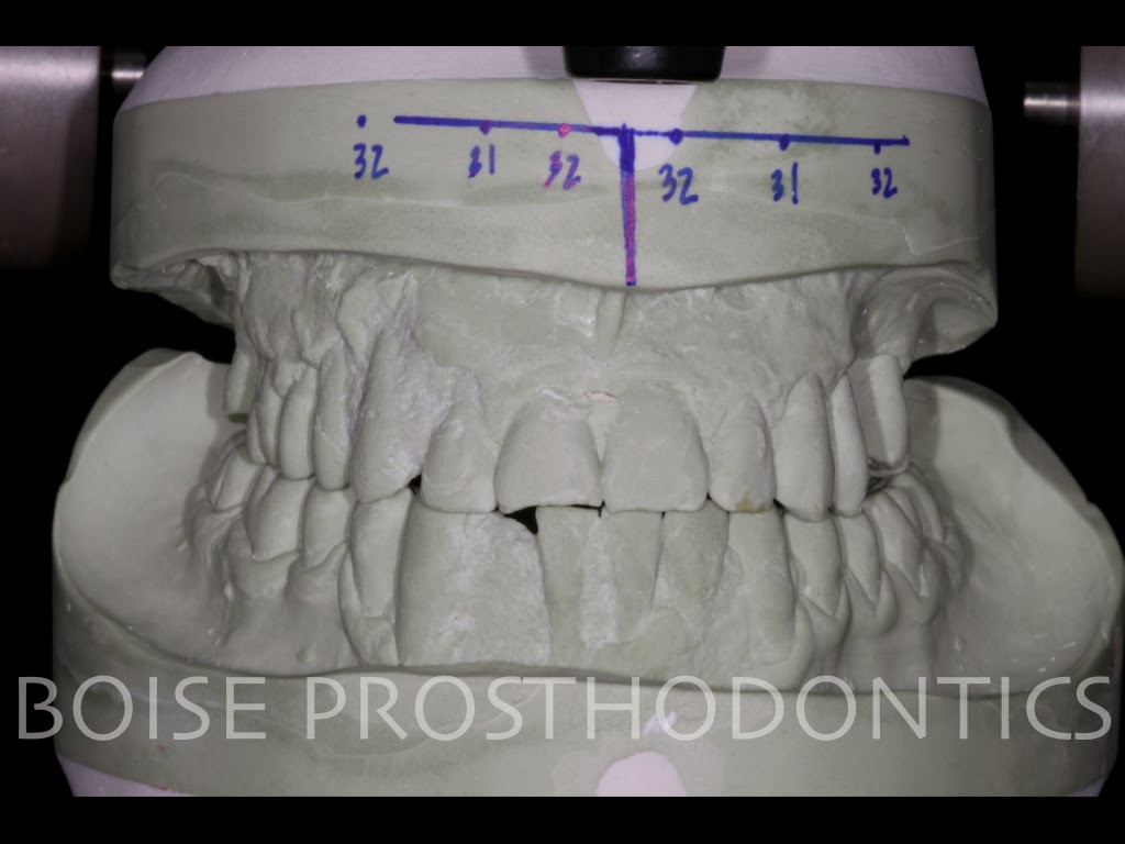 Boise Idaho Prosthodontics: True Immediate Maxillary Complete Denture ...