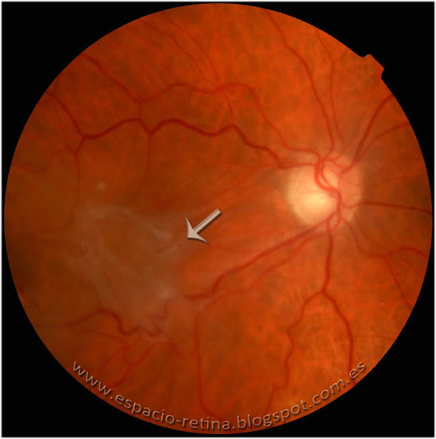 ESPACIO RETINA: Desprendimiento del vìtreo posterior.