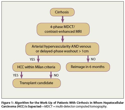 Liver Transplantation for the Treatment of Hepatocellular Carcinoma