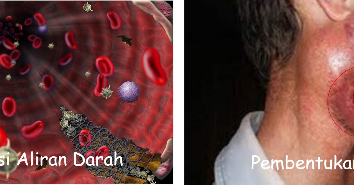 TATI HERBALS: DAFTAR OBAT HERBAL ABSES PADA LEHER DI APOTIK