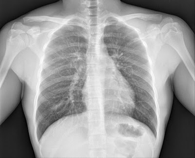 Chest X Ray Post Trauma - Radiology Imaging