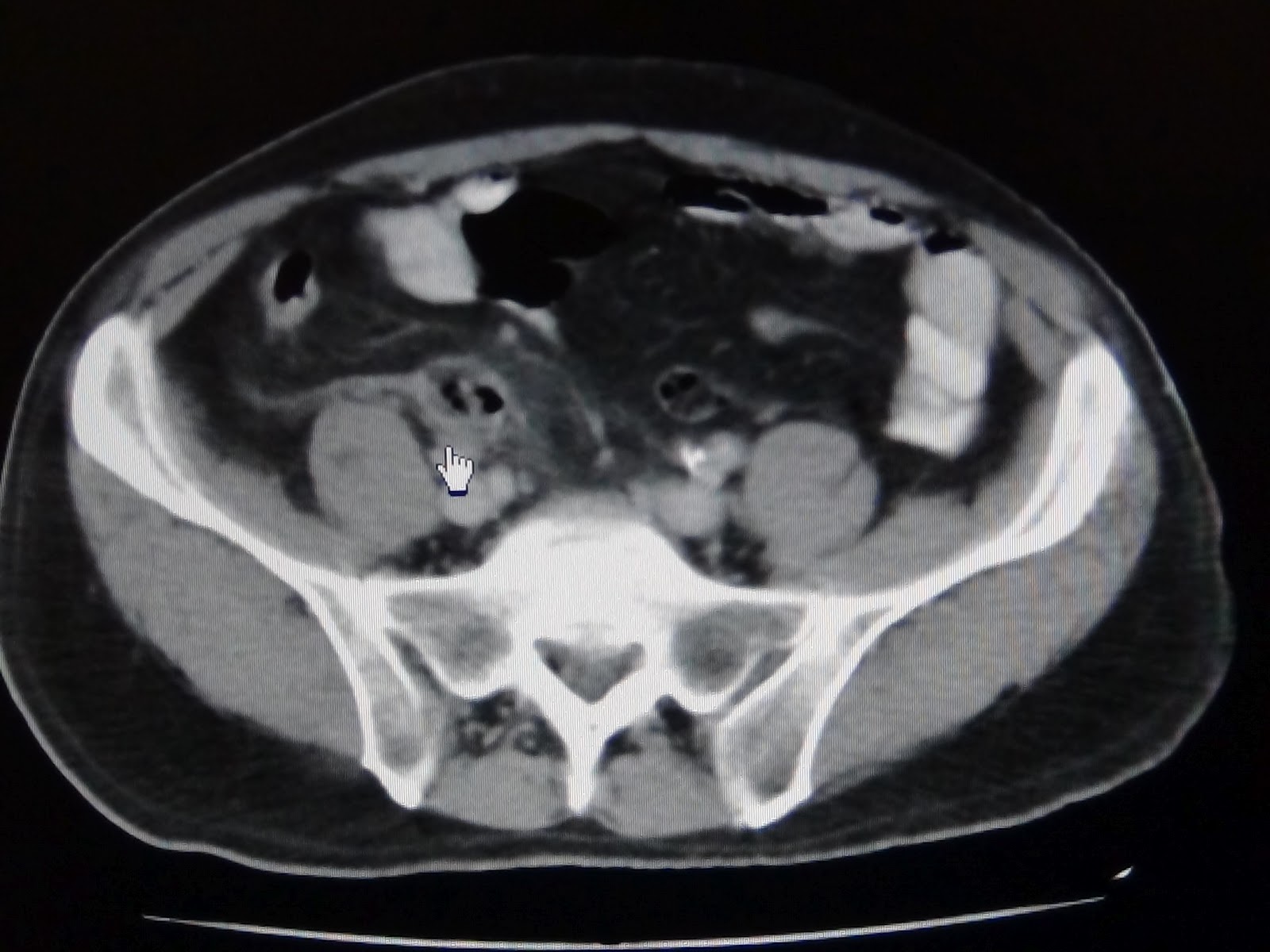 Endoscopia y Cirugía Digestiva: Apendicitis aguda perforada.