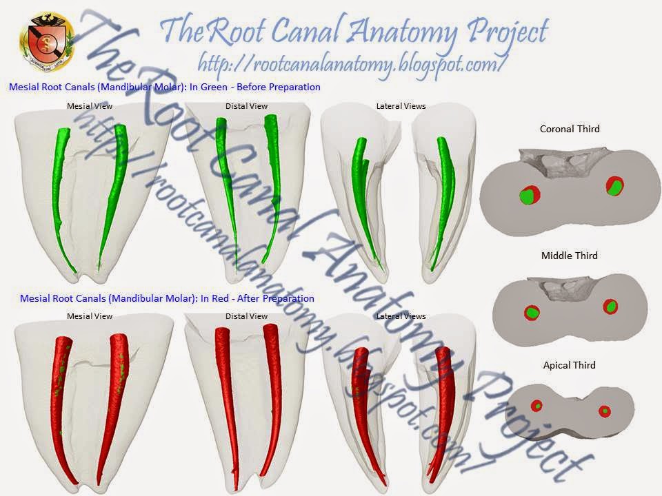 The Root Canal Anatomy Project: Root Canal Anatomy X Rotary Preparation