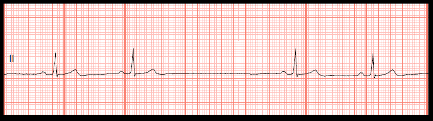Practice EKG Strips