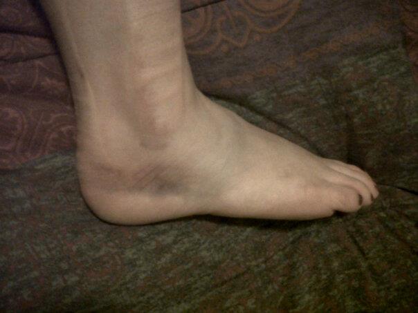 How Do I Love Thee?... Let Me Count The Ways...: 2 Sprained Ankles in 2 ...