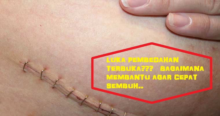 Kembara Kami...: LUKA PEMBEDAHAN TERBUKA?BAGAIMANA MEMBANTU AGAR CEPAT ...