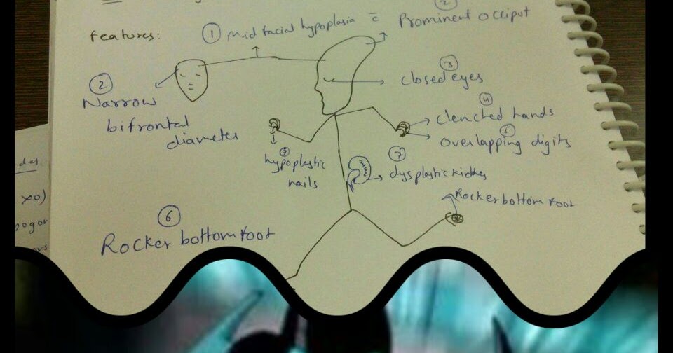 Medicowesome: Edward syndrome notes and mnemonic