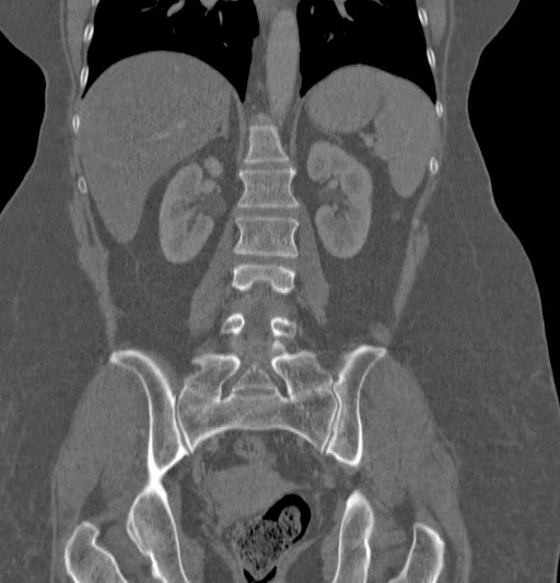 Ultimate Radiology : Castellvi Type IIIb LSTV