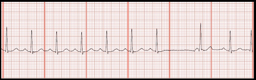 EKG Rhythm Strip Quiz 94: Ectopy and Escape Beats