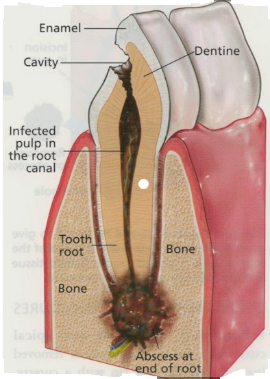 DINESH'S DENTAL PARADISE: A dental abscess or tooth abscess or ...