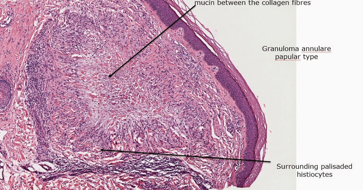 Dermatopathology Made Simple - Inflammatory: Granulomatous Reaction Pattern