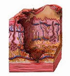 SISTEM INTEGUMENT DENGAN COMBUSTIO/ LUKA BAKAR ~ Ns Retno Ariyani