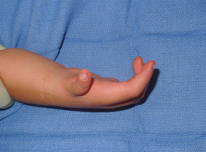 More thoughts on Pollicization | Congenital Hand and Arm Differences ...