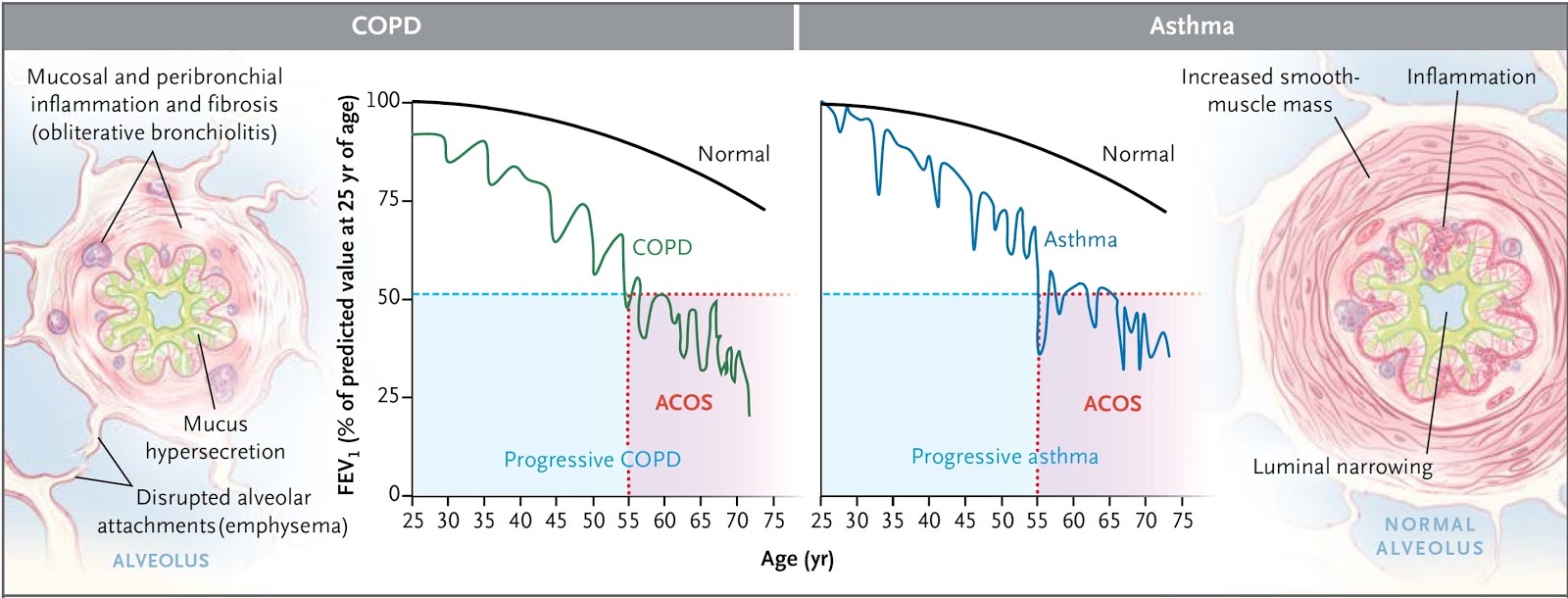 White Tower・White Jungle: The Asthma-COPD Overlap Syndrome (ACOS)