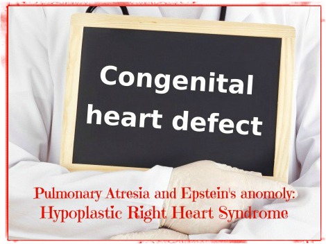 Living the Diagnosis: Born With a Small Right Ventricle: A Hypoplastic ...