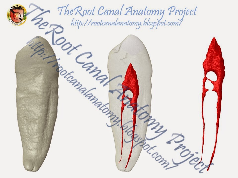 The Root Canal Anatomy Project: Mandibular First Premolar: Two Root Canals