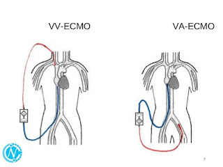 ER goldbook: ECMO (2/6): Vascular Access
