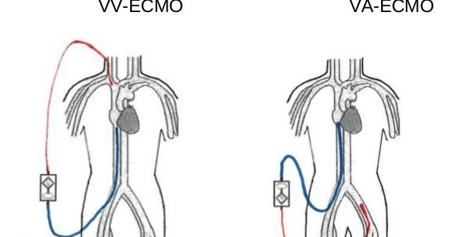 ER goldbook: ECMO (2/6): Vascular Access