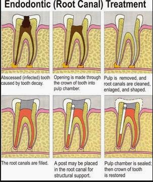 Omni Dental Group: Cracked Tooth Syndrome (CTS)