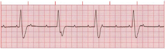 Third Degree Atrioventricular Block (Blok AV Derajat III) - JANTUNG OKE