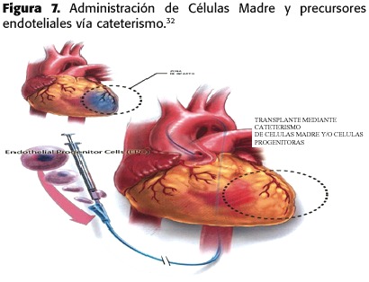 CARDIOPATÍA ISQUÉMICA