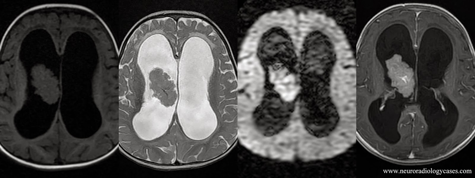 Dr Balaji Anvekar Frcr Choroid Plexus Papilloma Mri