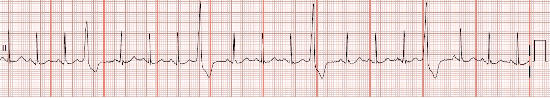 EKG Rhythm Strips 44