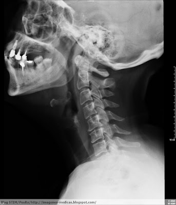 Posiciones Radiográficas de STIM: Rx Columna cervical (P)