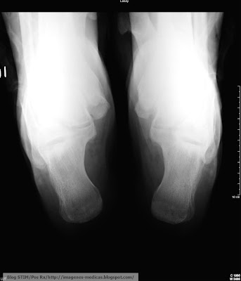 Posiciones Radiográficas de STIM: Rx Calcáneos (Axial)