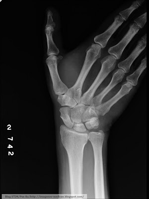 Posiciones Radiográficas de STIM: Rx Muñeca (Fte) con Desviación ...