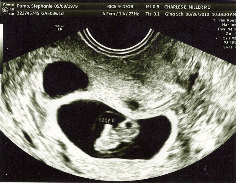 APRIL IT IS!: ...And I Have a Perigestational Bleed!