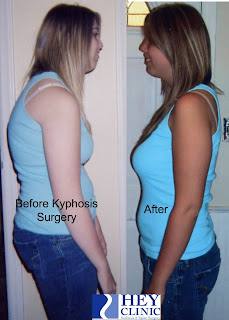 Dr. Lloyd Hey's Blog: Scoliosis and Spine Care, Aviation Safety and ...