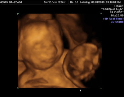 It's Always Something: 22 Weeks - Perfection