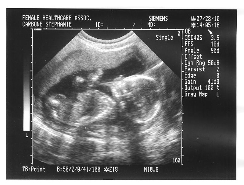 Been Given Grace: 19 week Ultrasound Pictures