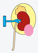 :::simple medicine:::: - TNM Staging of Renal cell carcinoma (illustrated).