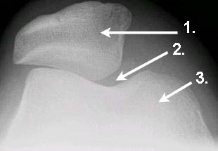 Lesiones de la Rodilla - Luxación de Rótula | Centro Médico Interlomas ...