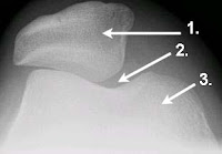 Lesiones de la Rodilla - Luxación de Rótula | Centro Médico Interlomas ...