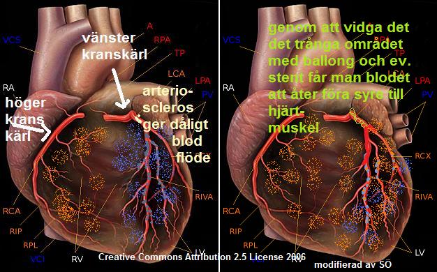Do not lose your grip -Tappa inte taget: CCSVI ballongvidgning, stentar ...