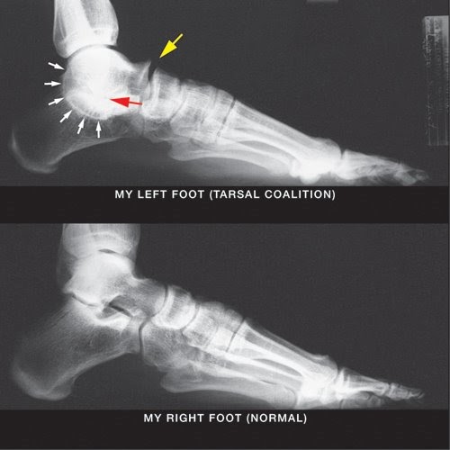 Tarsal Coalition: Radiology