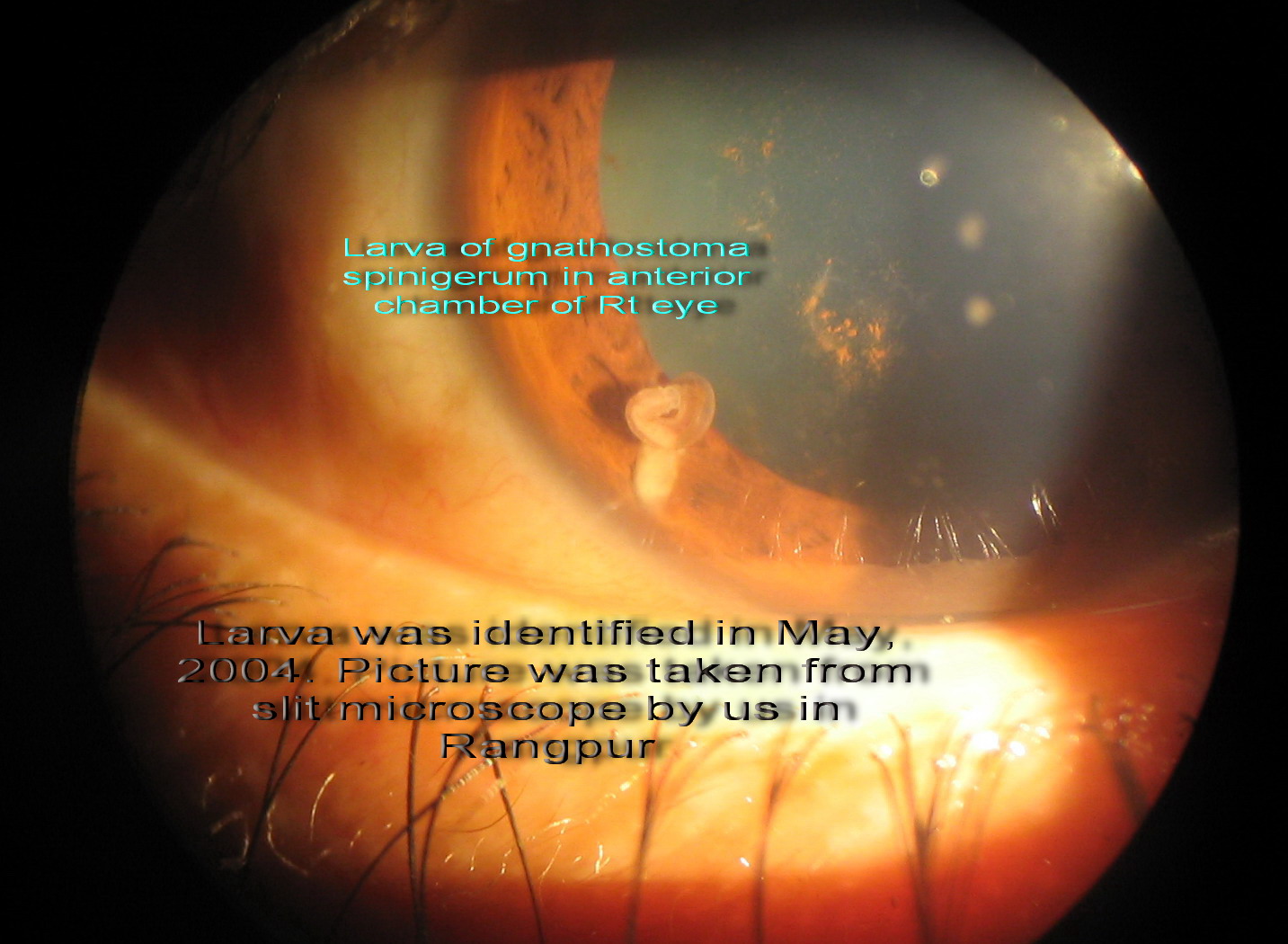 WE SHOULD KNOW: Gnathostomiasis - A Rare Nematode Infection: The Second ...